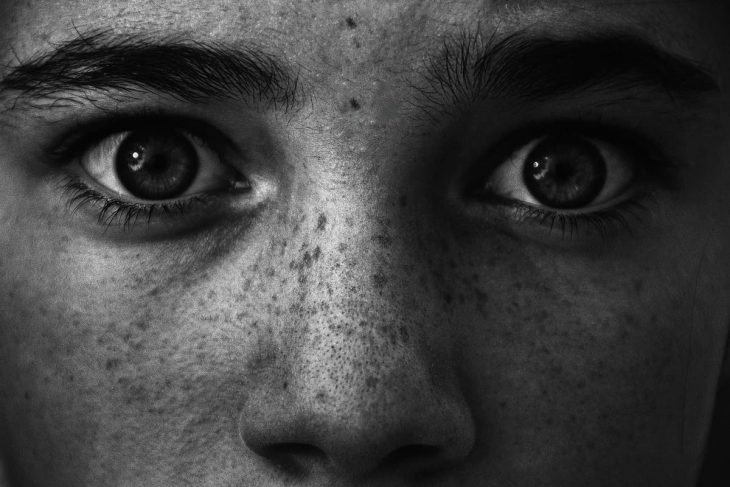 Bungang Araw: What Happens When it Gets Infected? - ModernFilipina.ph